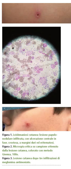 La leishmania in età pediatrica | Area Pediatrica - Rivista ufficiale ...